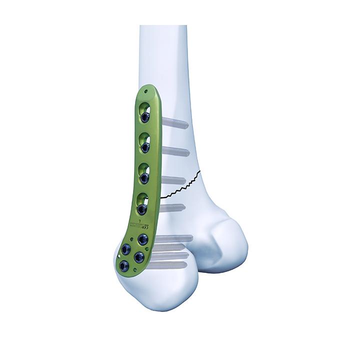 Placa De Titânio Para Fratura Condilar Femoral Medial Distal,fabricante ...